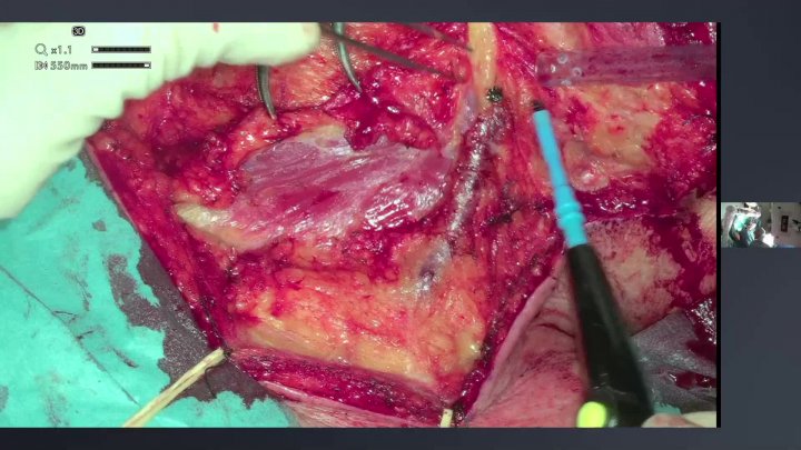 Left neck dissection levels II-III-IV :: Media :: European e-manual for ...