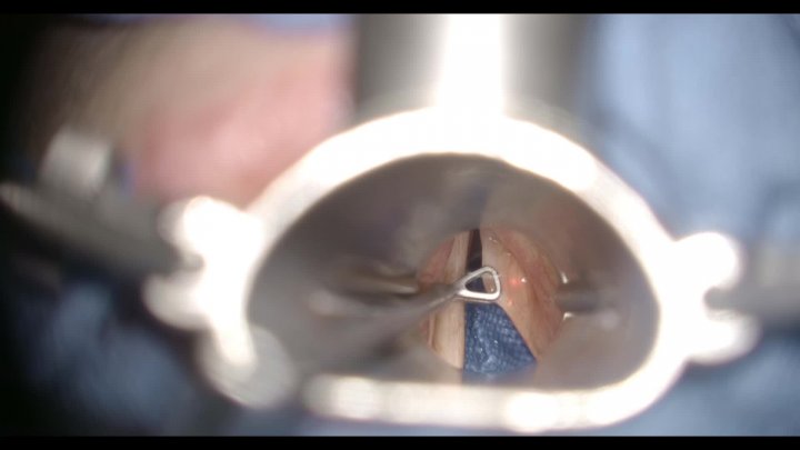 Subepithelial cordectomy right vocal cord :: Media :: European e-manual ...